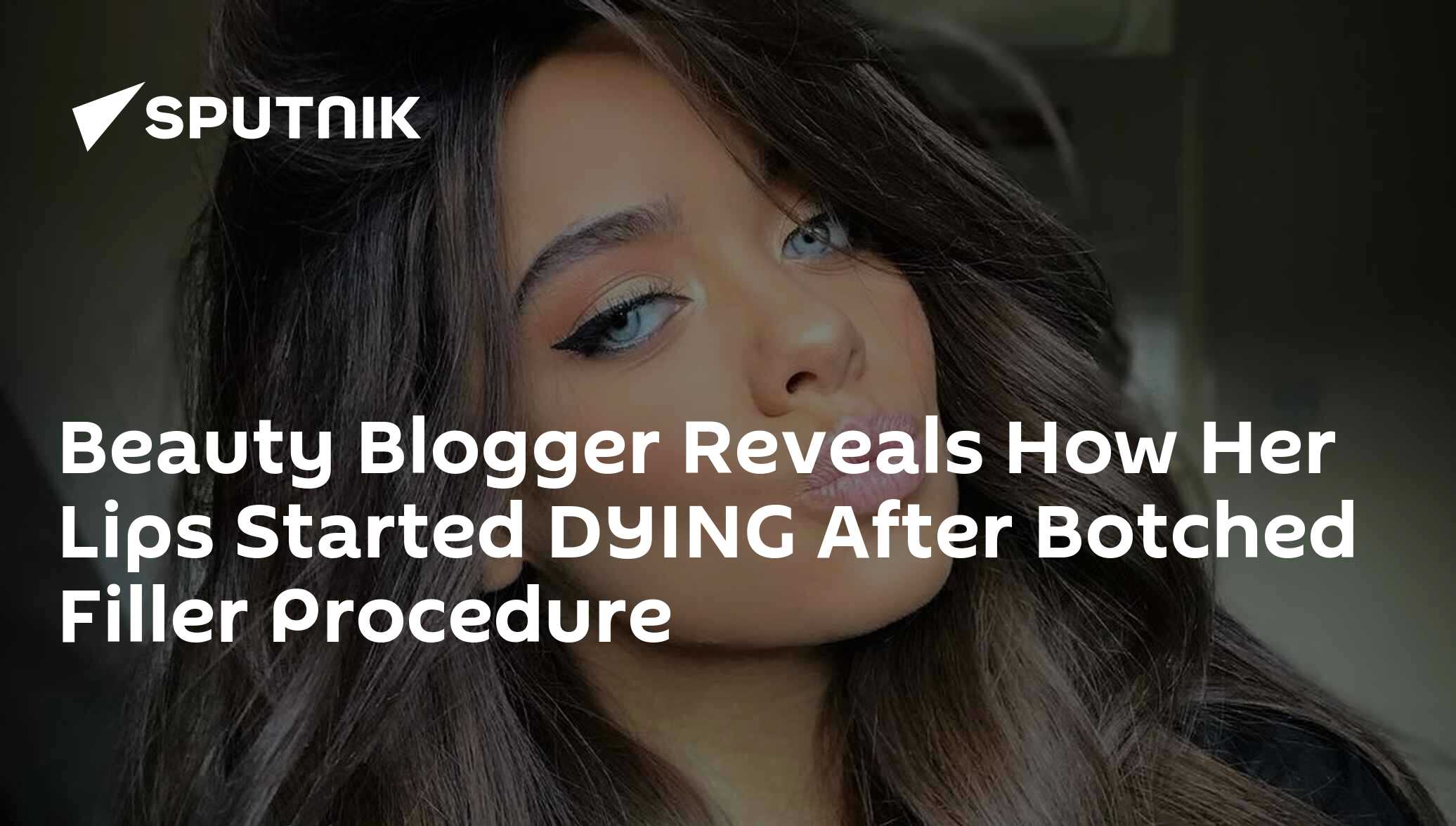 Beauty Blogger Reveals How Her Lips Started DYING After Botched Filler ...