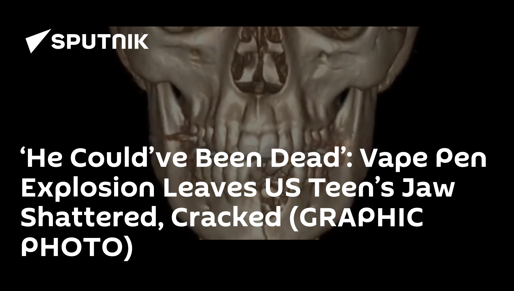 ‘He Could’ve Been Dead’: Vape Pen Explosion Leaves US Teen’s Jaw ...