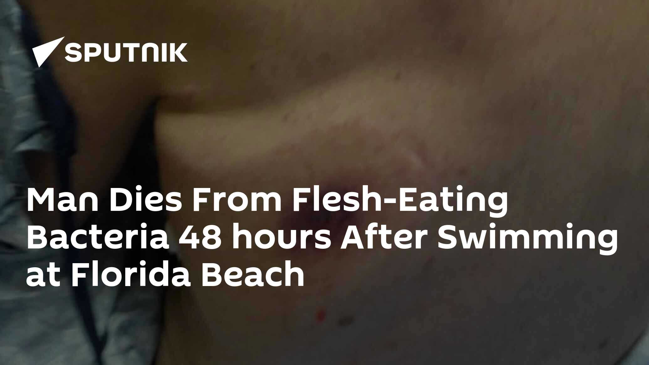 Man Dies From Flesh Eating Bacteria 48 Hours After Swimming At Florida
