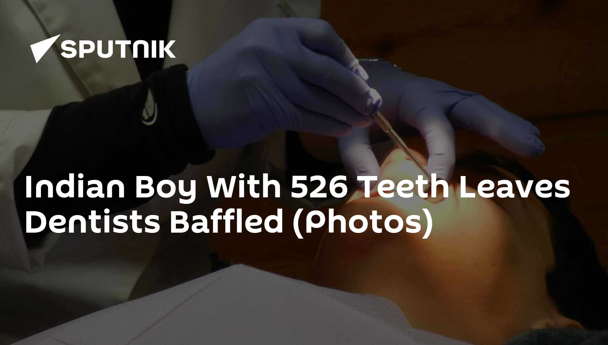 Indian Boy With 526 Teeth Leaves Dentists Baffled (Photos)