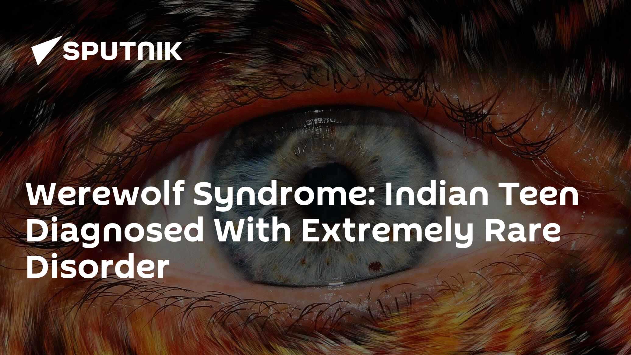 Werewolf Syndrome: Indian Teen Diagnosed With Extremely Rare Disorder ...